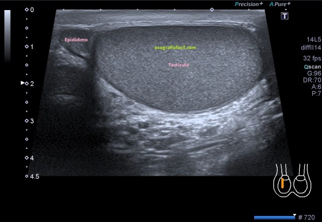 Ecografía De Túnica Albugínea Tunica Albuginea Cyst Mimicking An