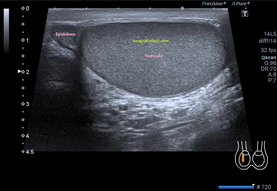 261. Prótesis Testicular. – Ecografía Fácil