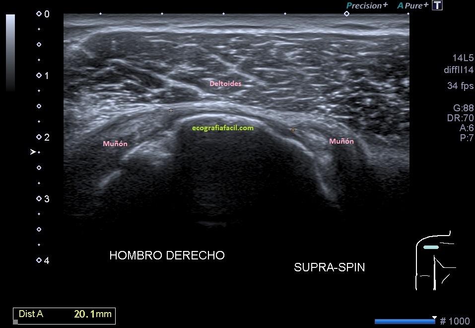 191. Rotura de Tendón Supraespinoso. Tipos y Semiología. – Ecografía Fácil