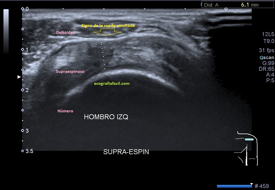Rotura – Ecografía Fácil