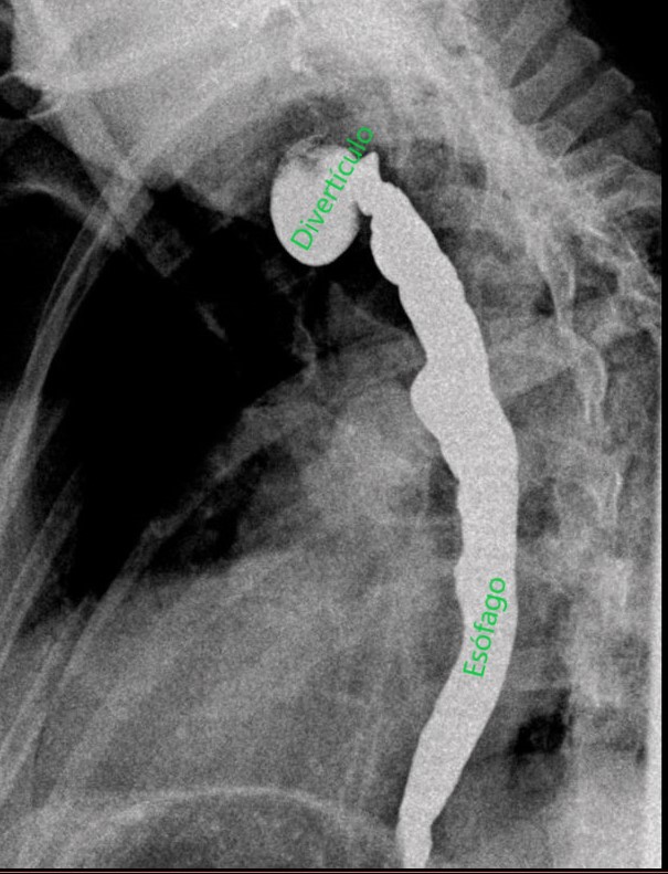 Divertículo esofágico por ecografía – Ecografía Fácil