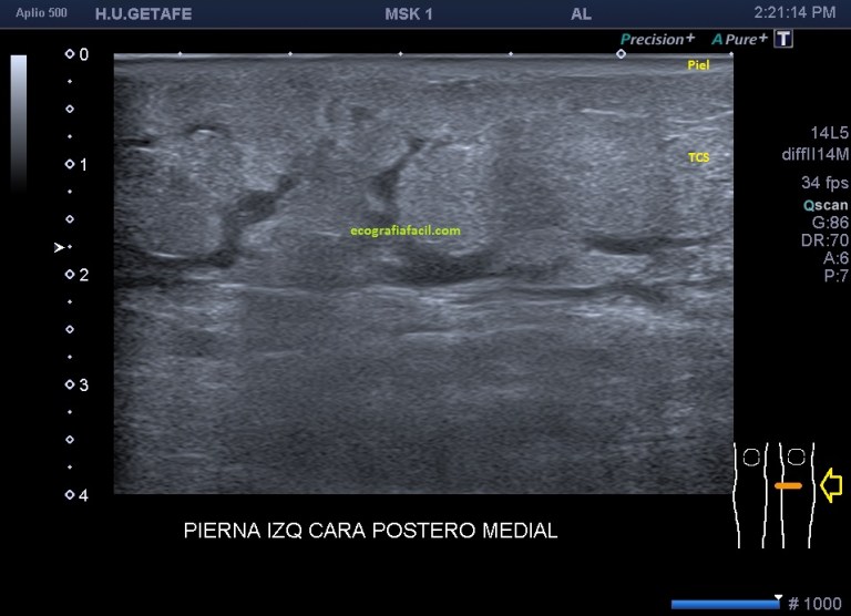 Edema – Ecografía Fácil