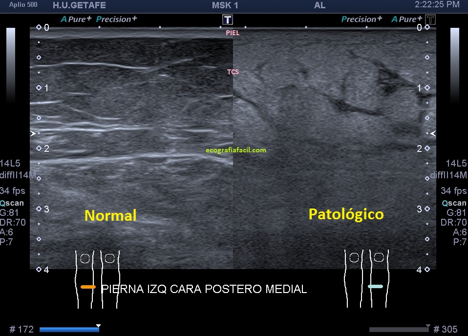 Edema – Ecografía Fácil