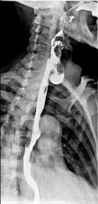 Divertículo esofágico por ecografía – Ecografía Fácil