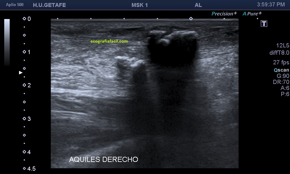Calcificaciones distróficas – Ecografía Fácil