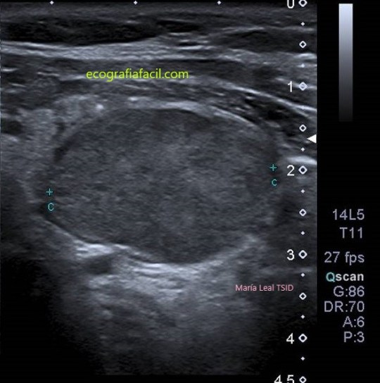 208. Clasificación Ti-Rads. Nódulos tiroideos. – Ecografía Fácil