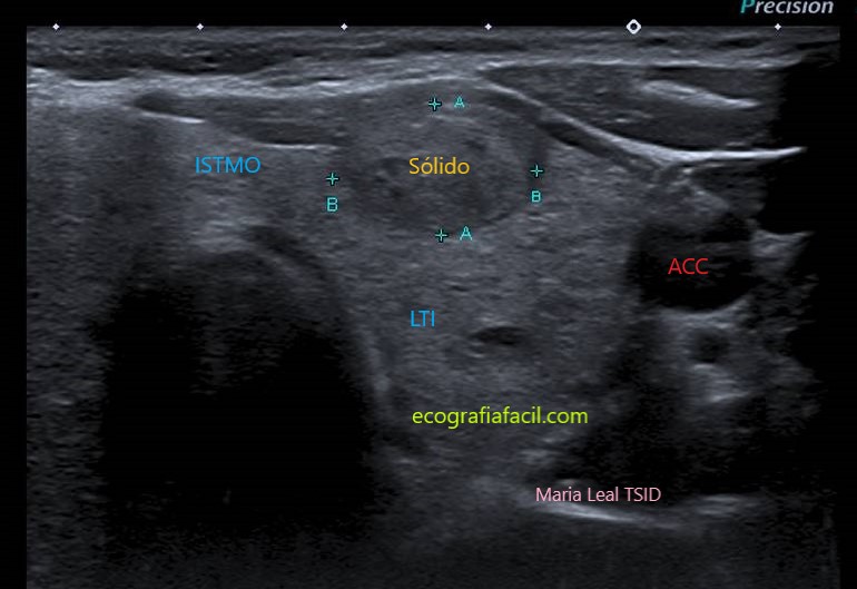 208. Clasificación Ti-Rads. Nódulos tiroideos. – Ecografía Fácil