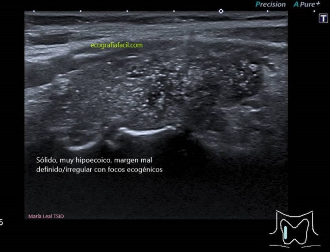208. Clasificación Ti-Rads. Nódulos tiroideos. – Ecografía Fácil