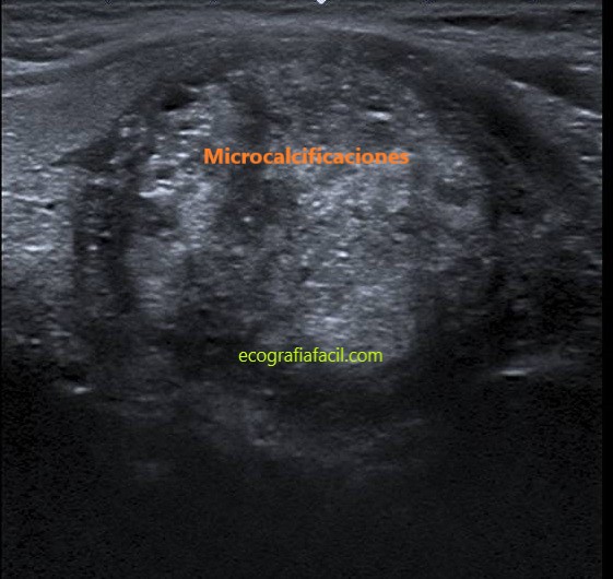 208. Clasificación Ti-Rads. Nódulos tiroideos. – Ecografía Fácil