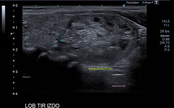 Ti-Rads – Ecografía Fácil