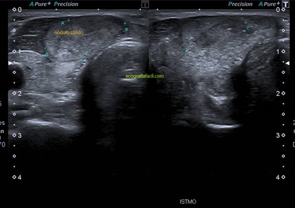 208. Clasificación Ti-Rads. Nódulos tiroideos. – Ecografía Fácil