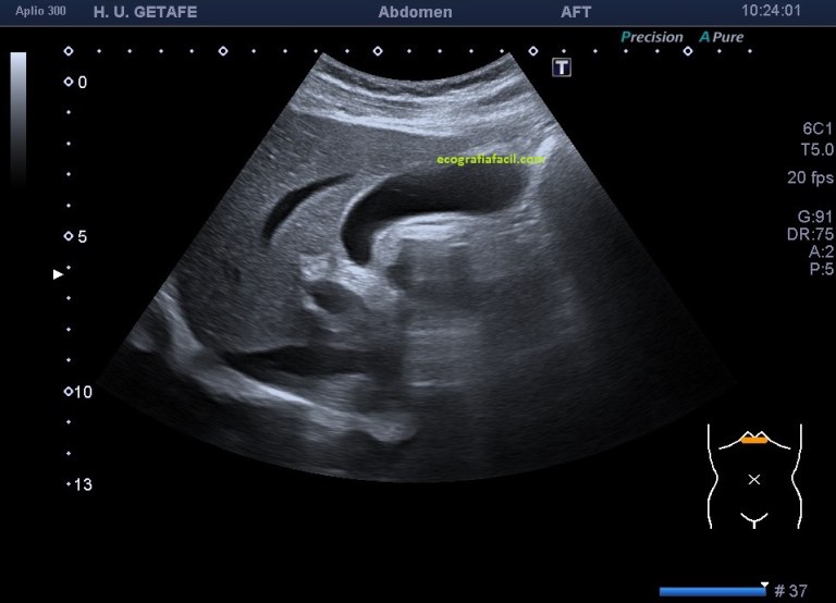 Barro biliar – Ecografía Fácil