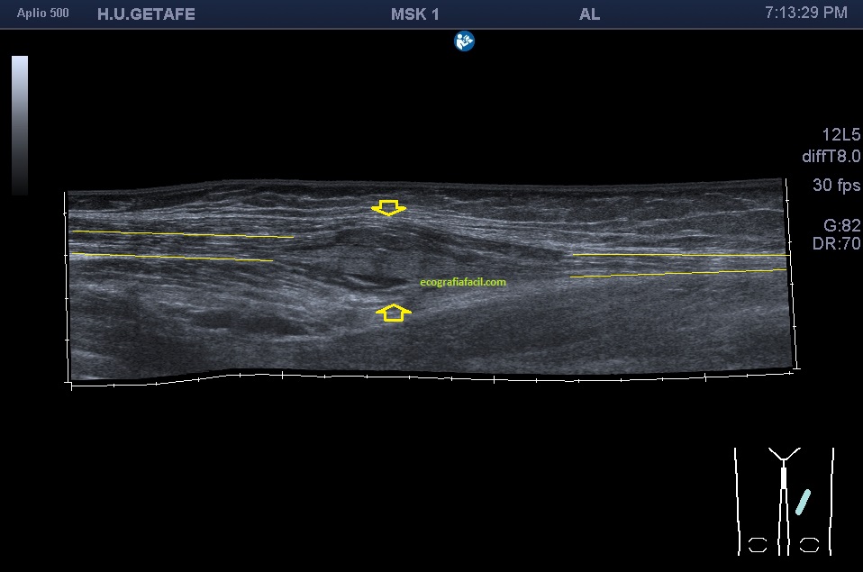 Rotura fibrilar – Ecografía Fácil