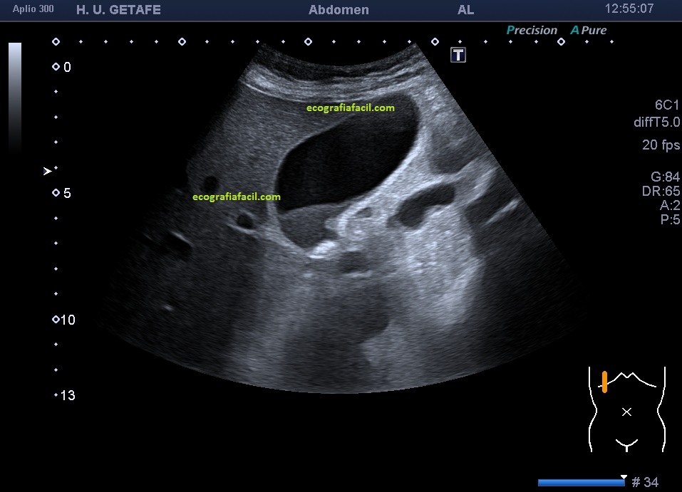 Barro biliar – Ecografía Fácil