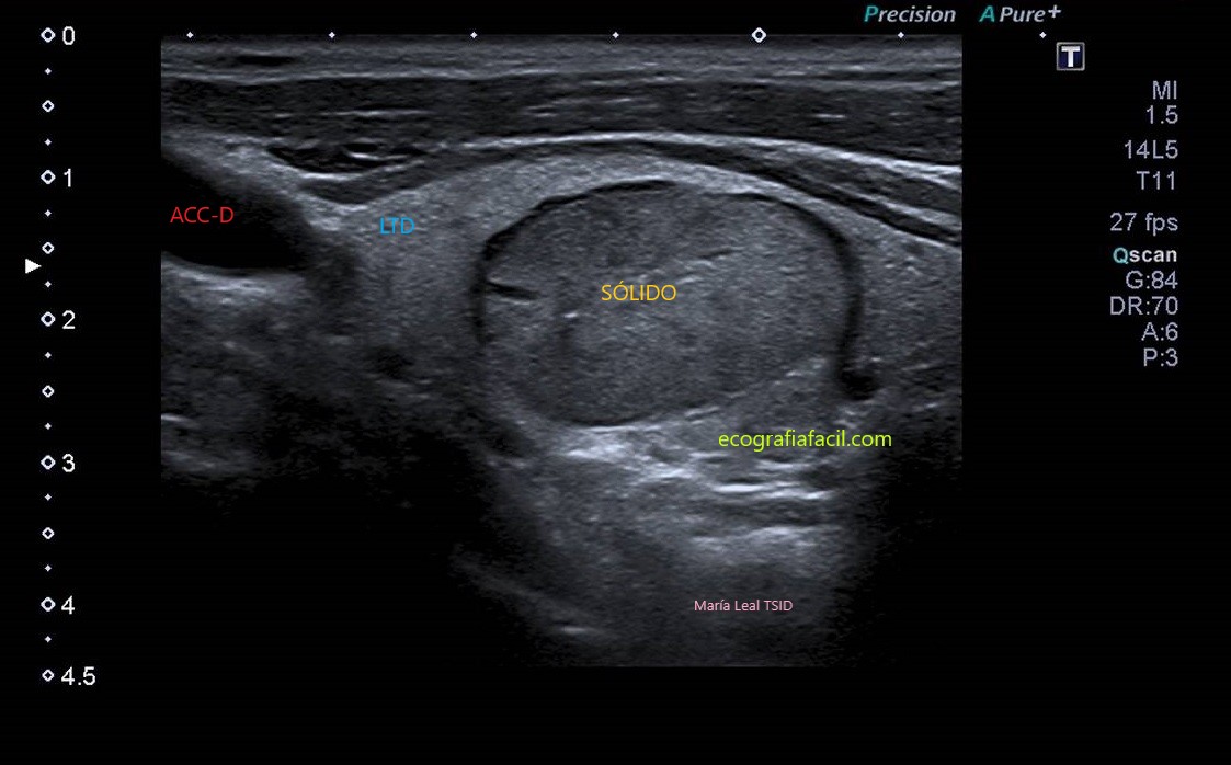 Ti-Rads – Ecografía Fácil