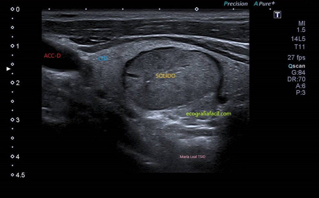 208. Clasificación Ti-Rads. Nódulos tiroideos. – Ecografía Fácil