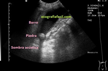 Barro biliar – Ecografía Fácil