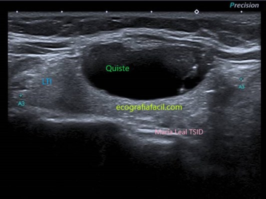 208. Clasificación Ti-Rads. Nódulos tiroideos. – Ecografía Fácil