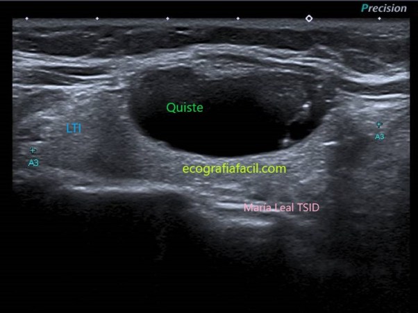 208. Clasificación Ti-Rads. Nódulos tiroideos. – Ecografía Fácil