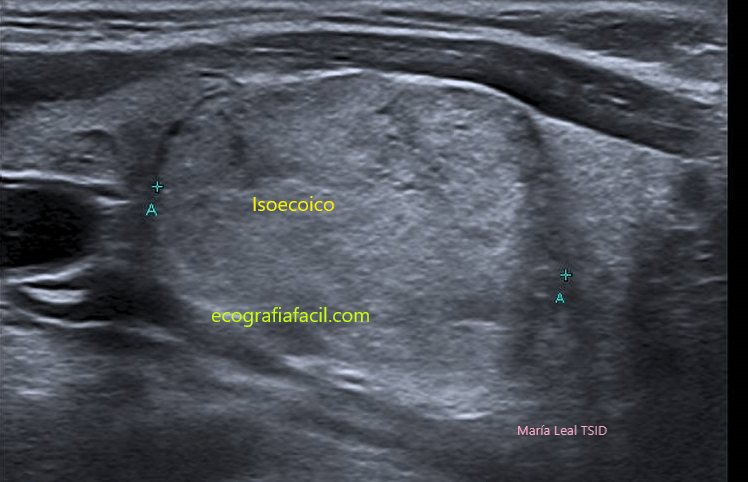 208. Clasificación Ti-Rads. Nódulos tiroideos. – Ecografía Fácil