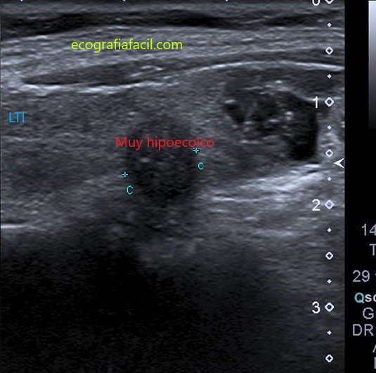 Ti-Rads – Ecografía Fácil