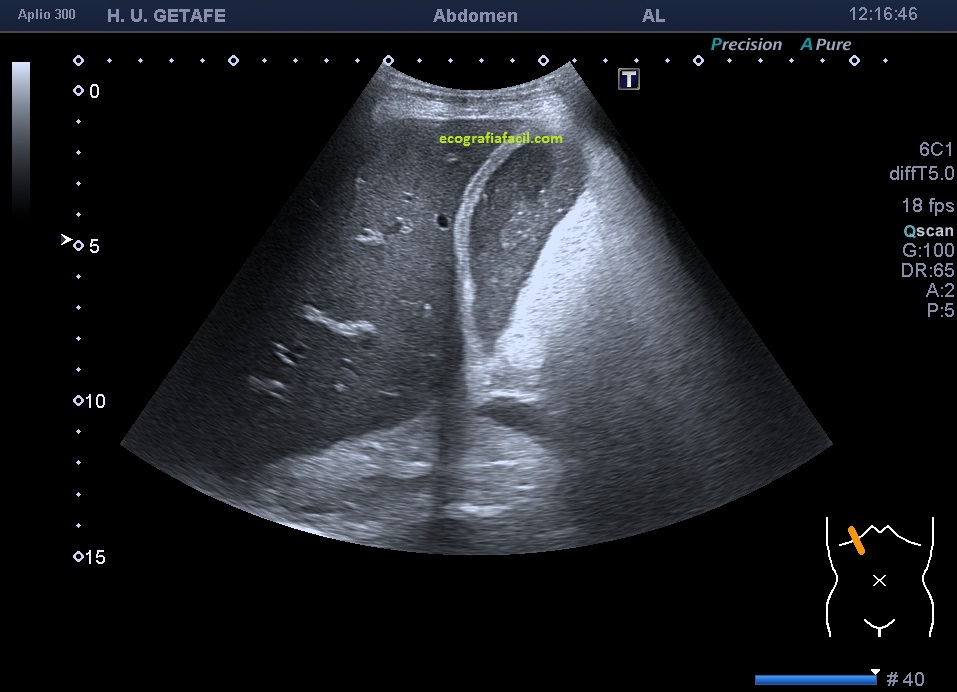 Barro biliar – Ecografía Fácil