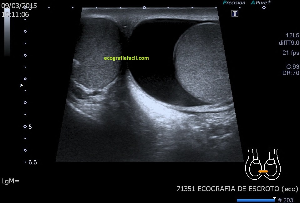 Escroto – Ecografía Fácil
