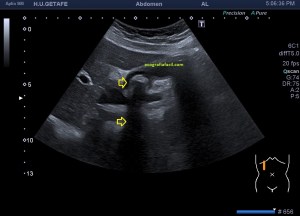 211. La Vesícula. – Ecografía Fácil