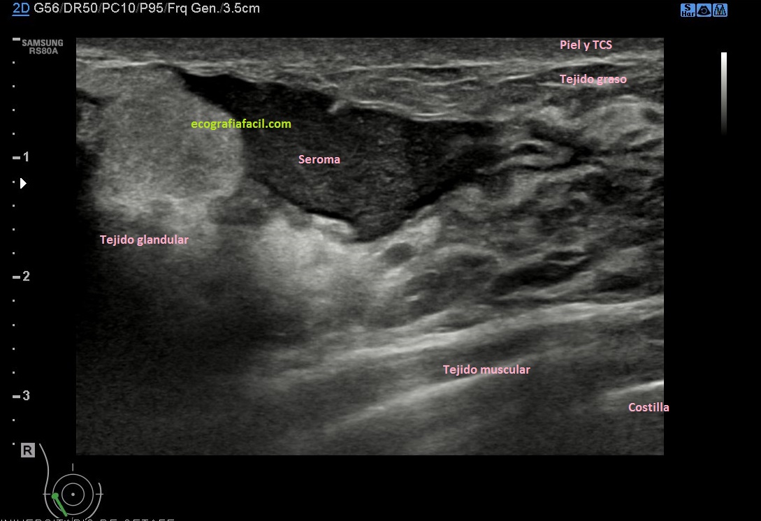 Seroma – Ecografía Fácil
