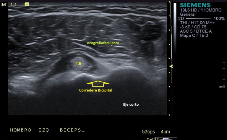 Ecografía de Hombro – Ecografía Fácil