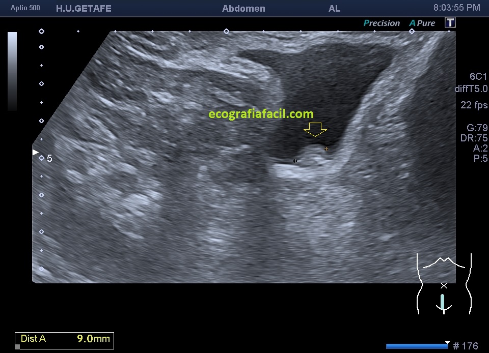 Vejiga – Ecografía Fácil