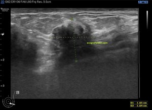 Mastopatía – Ecografía Fácil
