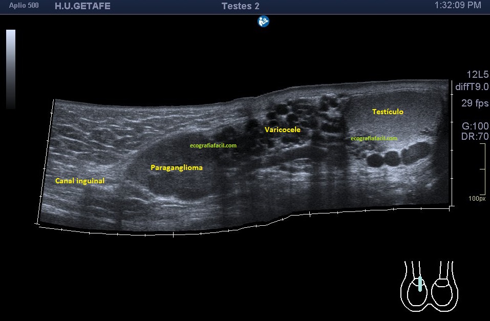 Doppler Color – Ecografía Fácil
