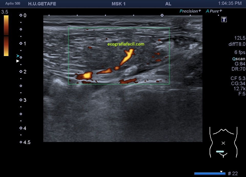 Doppler Color – Ecografía Fácil