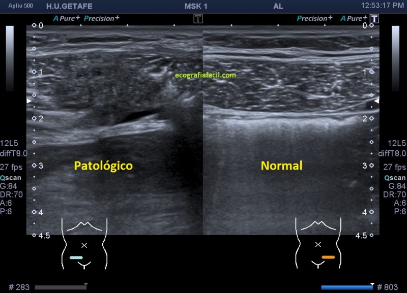 Doppler Color – Ecografía Fácil