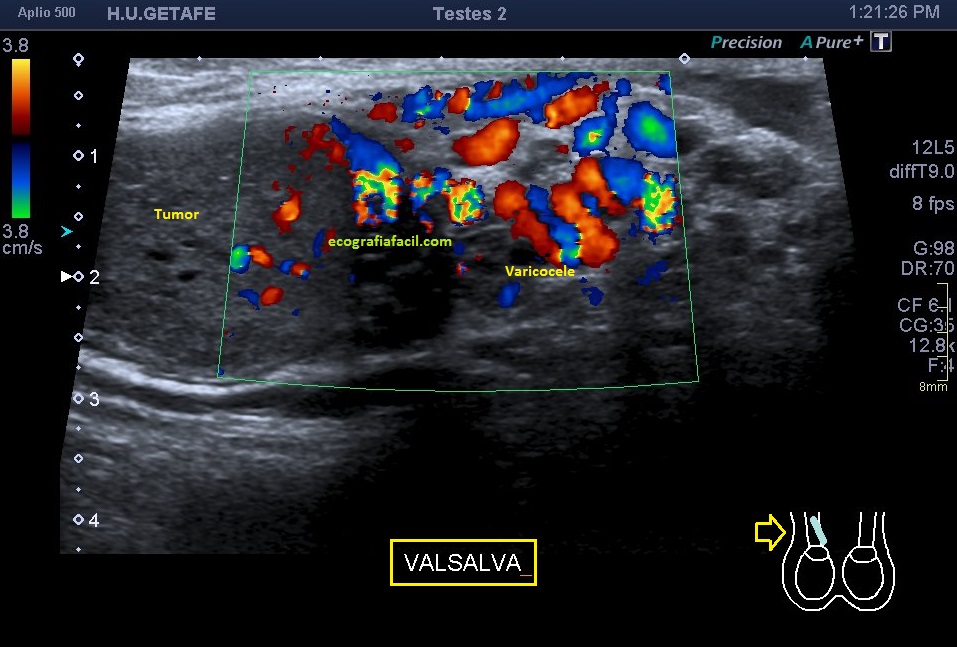 Doppler Color – Ecografía Fácil