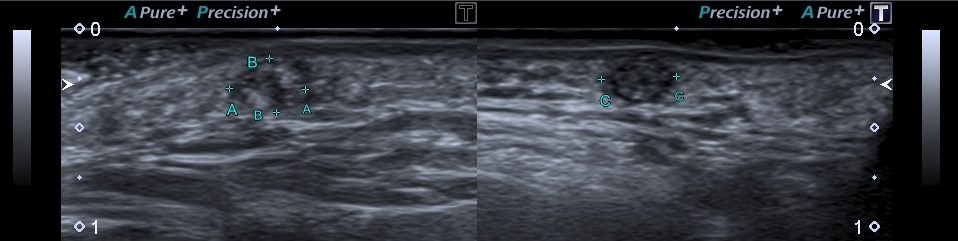 Pilomatricoma – Ecografía Fácil