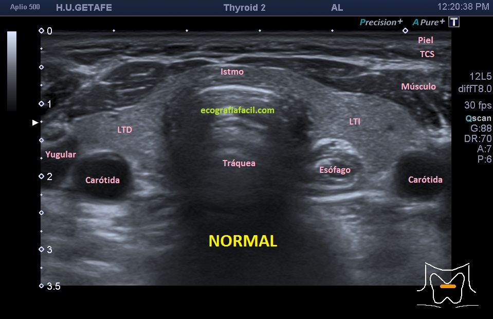 Tiroides – Ecografía Fácil