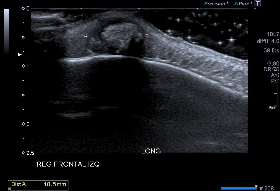 Quiste epidermoide – Ecografía Fácil