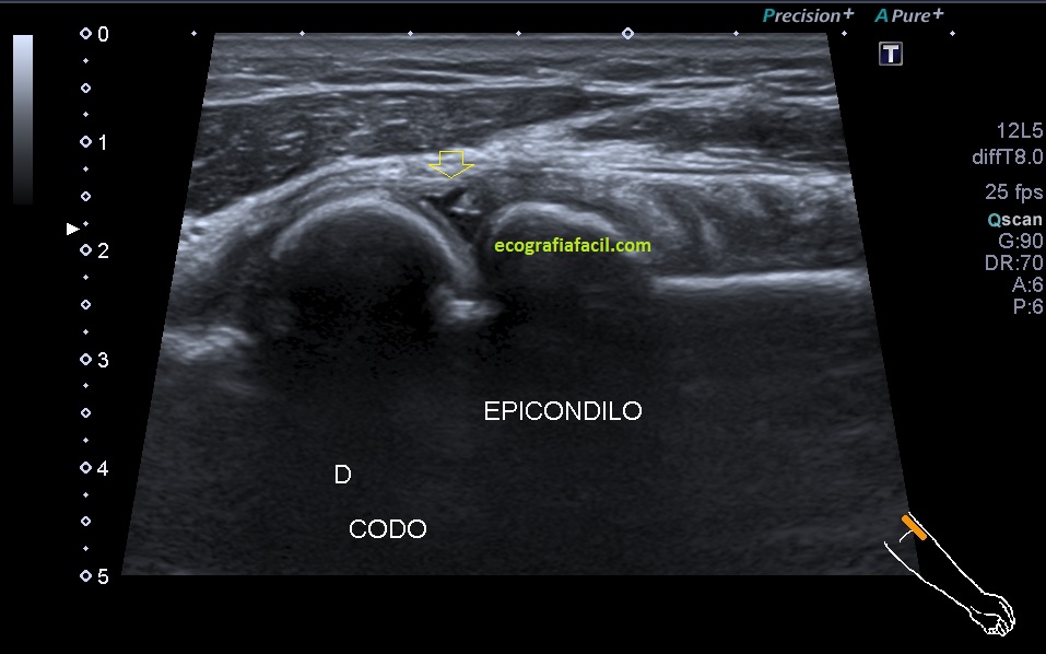 Codo – Ecografía Fácil