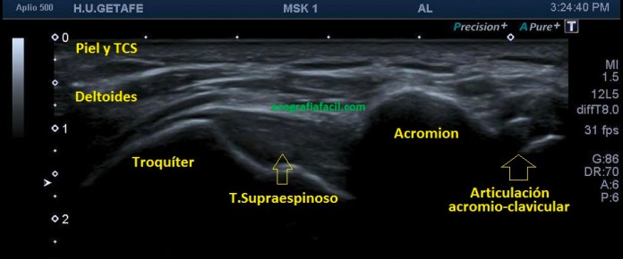 232. Impingement del Hombro – Ecografía Fácil