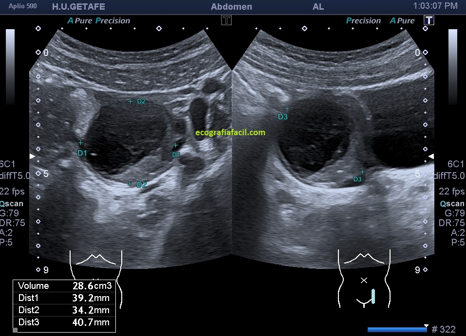 Quiste ovárico – Ecografía Fácil