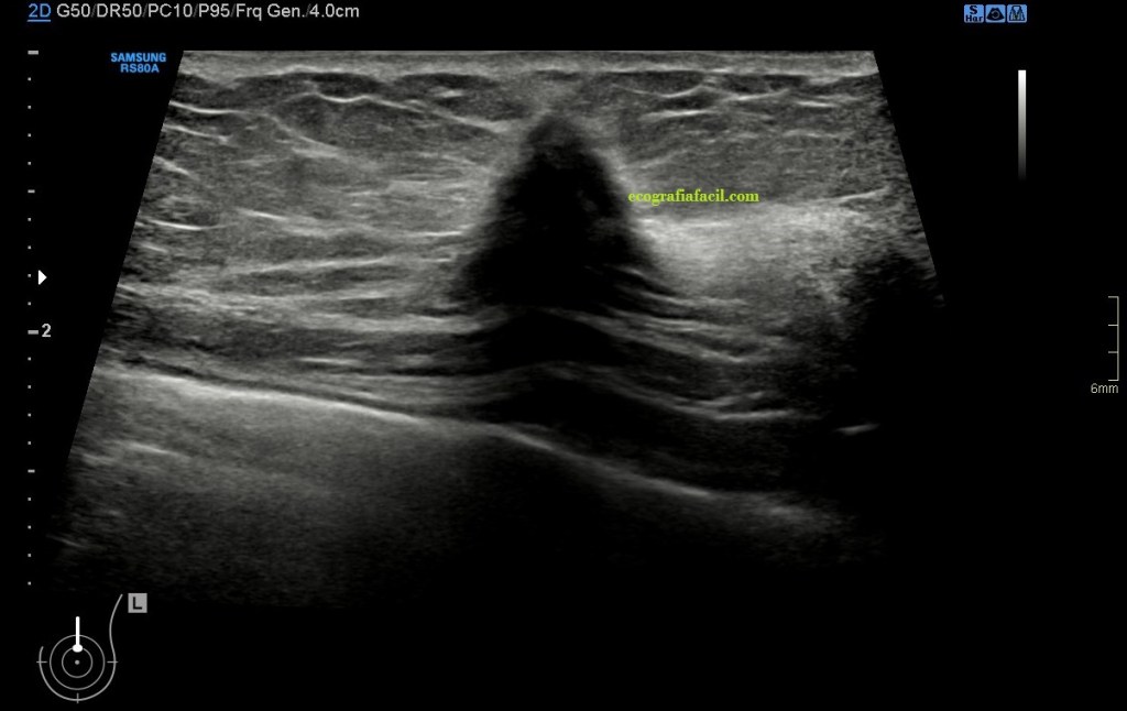 248. Clasificación Bi-Rads. – Ecografía Fácil