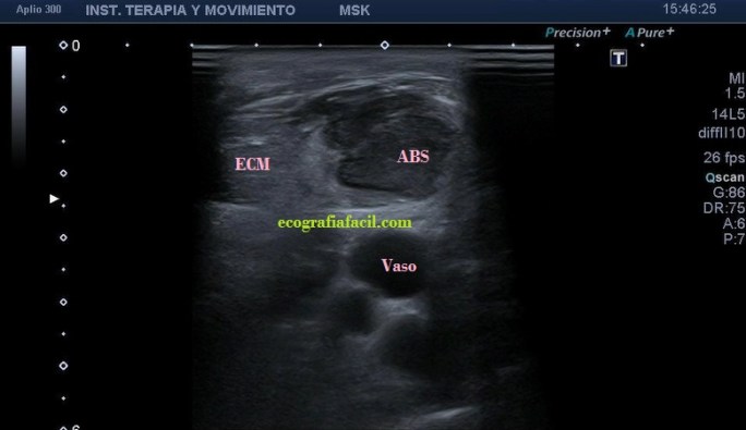 Esternocleidomastoideo – Ecografía Fácil