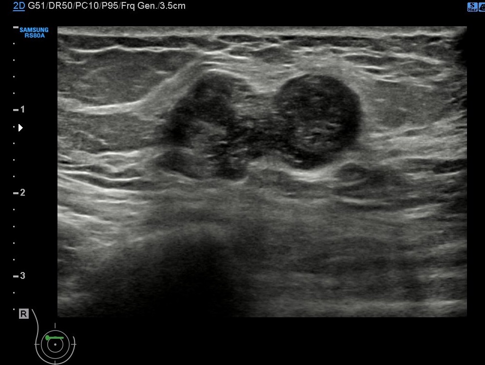Bi-Rads – Ecografía Fácil