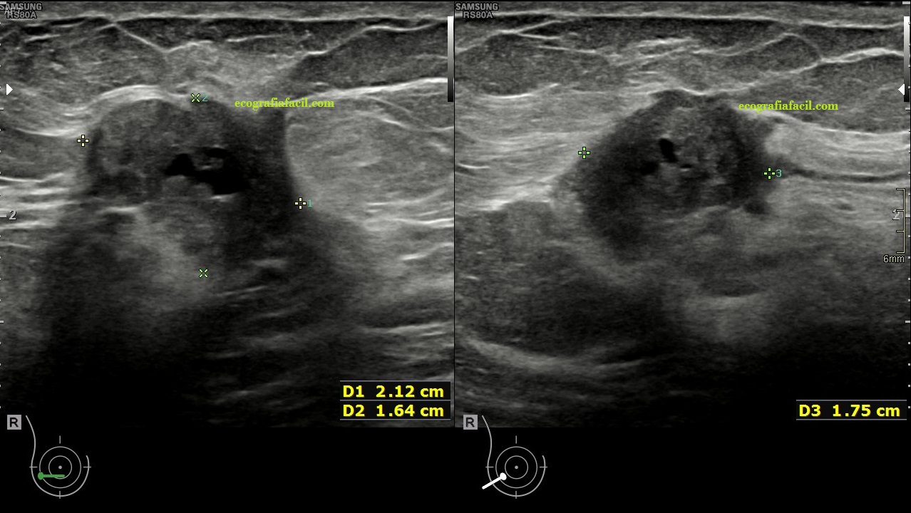 Bi-Rads – Ecografía Fácil