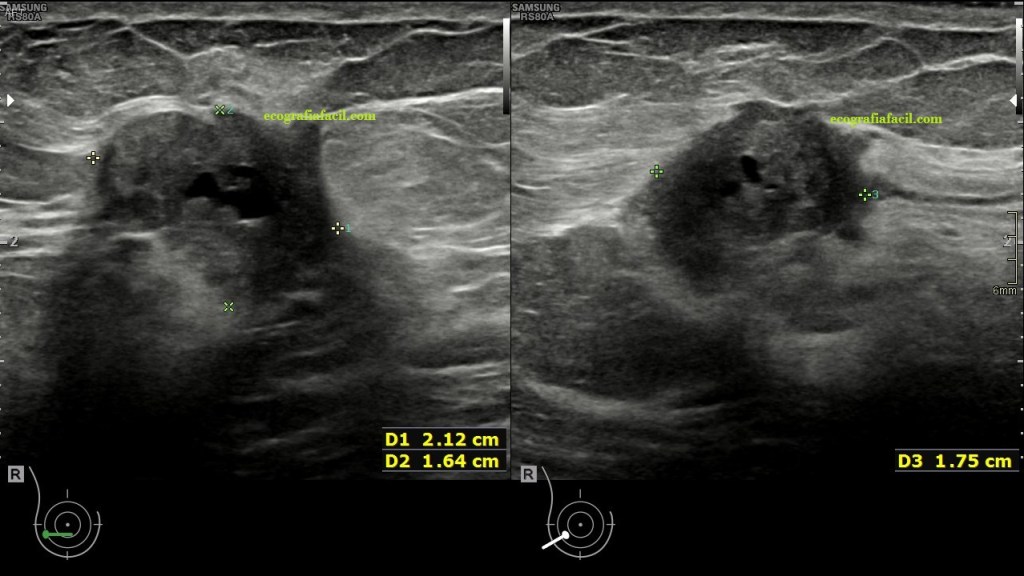 248. Clasificación Bi-Rads. – Ecografía Fácil