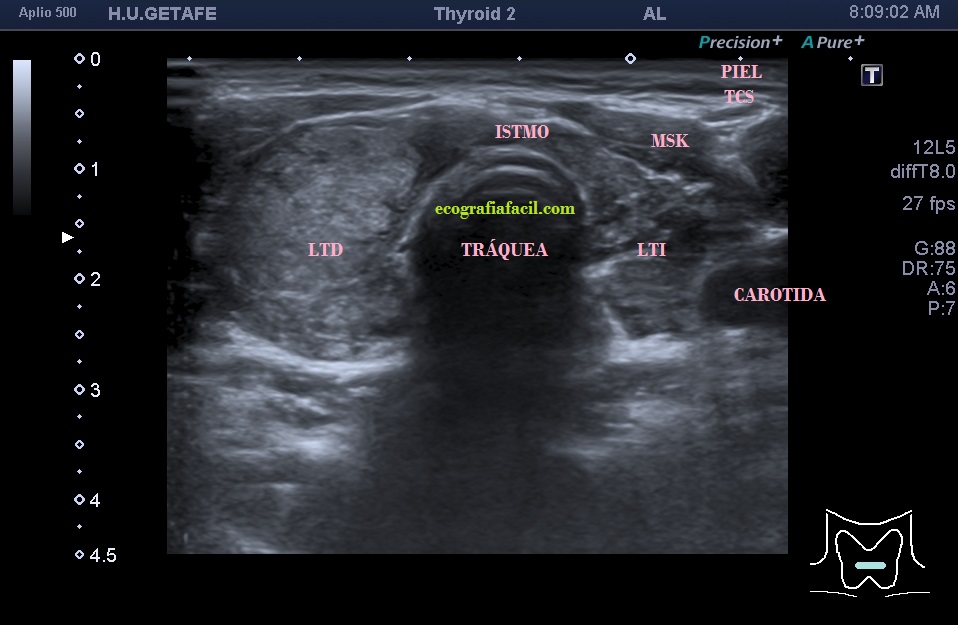 Tiroiditis – Ecografía Fácil