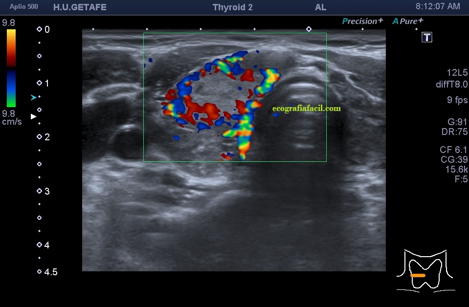 Tiroiditis – Ecografía Fácil