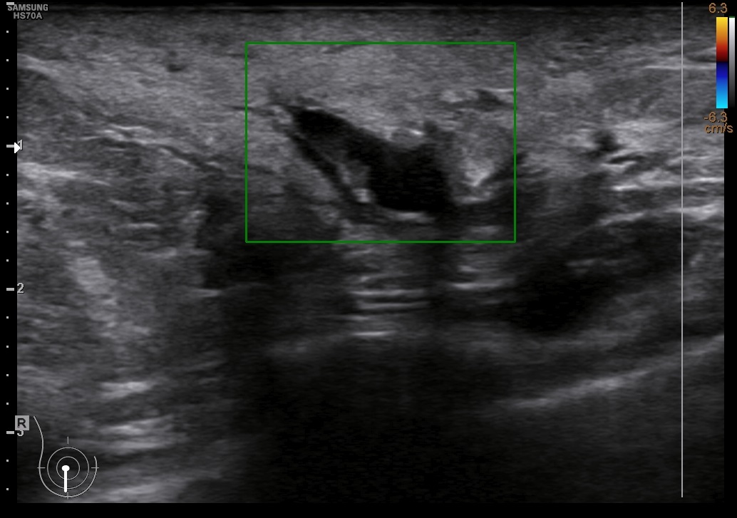 252. Mastitis. – Ecografía Fácil